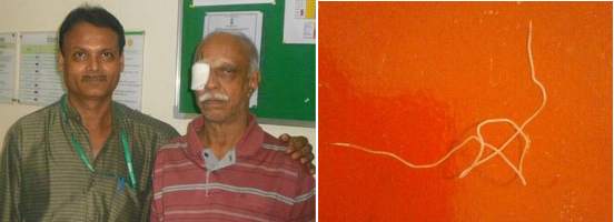 Sakit Tak Sembuh-sembuh, Ternyata Ada Cacing Hidup di Dalam Mata