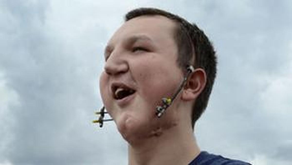 Rumitnya Mengatasi Kondisi Langka yang Menyertai Dagu Kecil Bayi Kirana