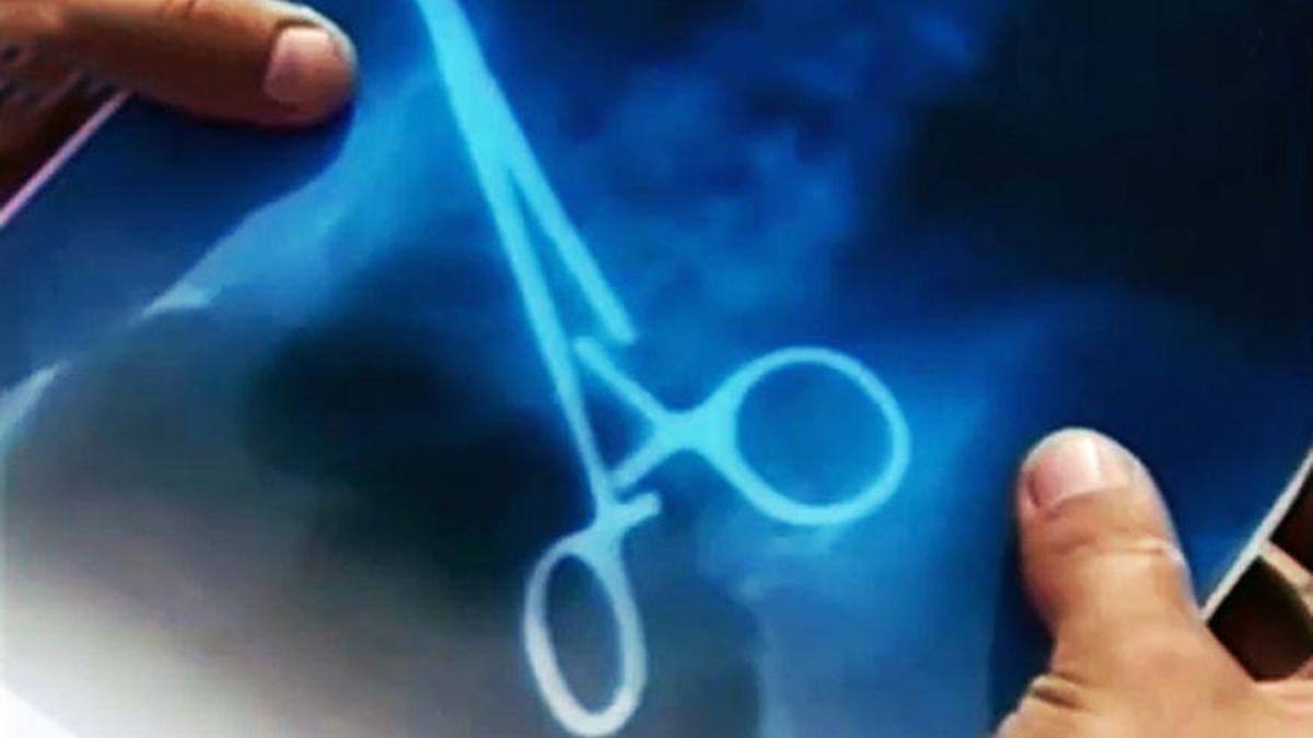 Setelah 3 Tahun Operasi Caesar, Baru Ketahuan Forceps Tertinggal di Perut
