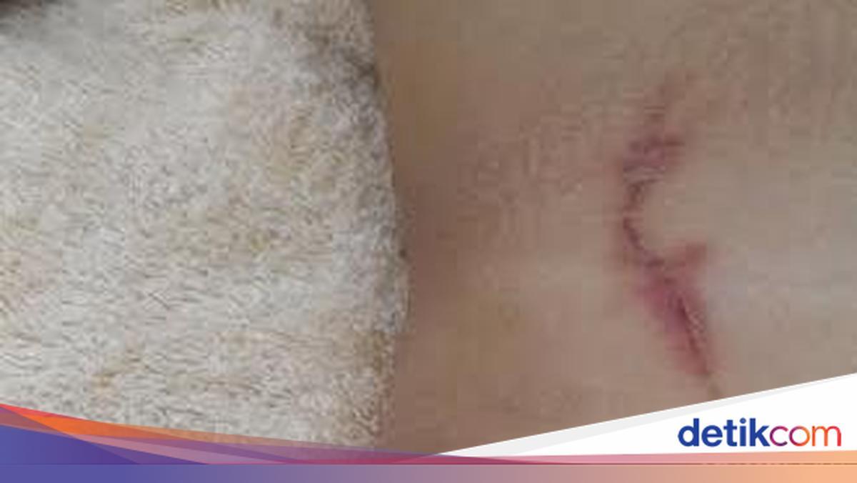 Bekas Gigitan Tomcat Seperti Apa? Ini Ciri-ciri dan Cara Menyembuhkannya
