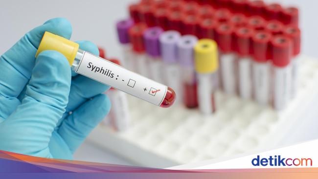 Sifilis Melonjak di RI, Ini Gejala Raja Singa yang Perlu Diwaspadai