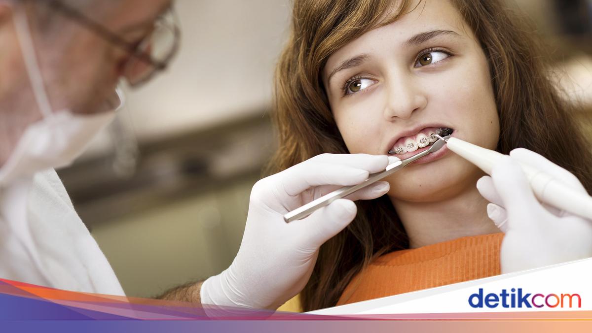 Behel Gigi: Jenis, Biaya Pasang, dan Efek Sampingnya