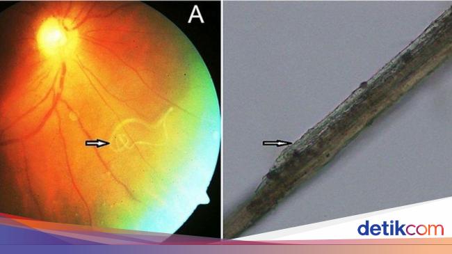 Penglihatannya Terganggu, Ternyata Ada Cacing di Mata Pria Ini