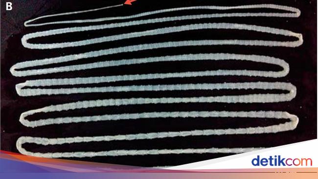 5 Tanda Kamu Mungkin Punya Cacing Parasit di Perut