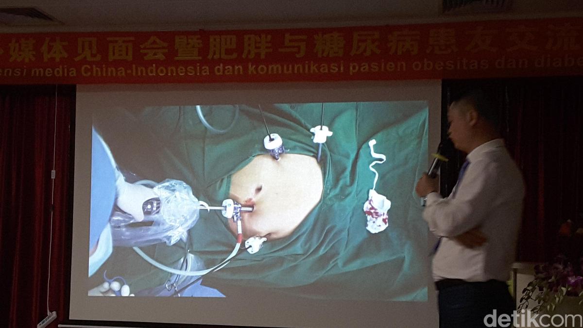 Pasien Diabetes 'Ringan' dan Obesitas, Disarankan Tidak Jalani Bypass ...