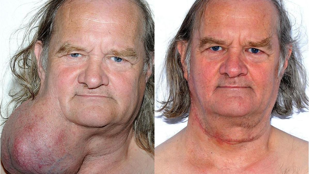 Kisah Ian, Hidup 25 Tahun dengan Tumor Sebesar Melon di Leher