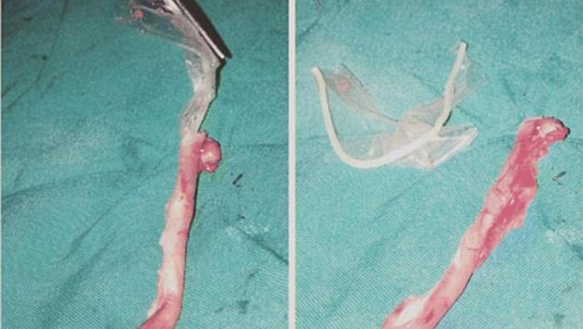 Tak Doyan Makan dan Perut Melilit, Ternyata Ada Kondom Sumbat Usus Buntu