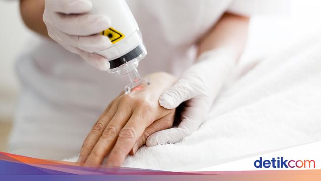 Yuk Ketahui Cara Kerja Terapi Laser untuk Bantu 'Hilangkan' Tato