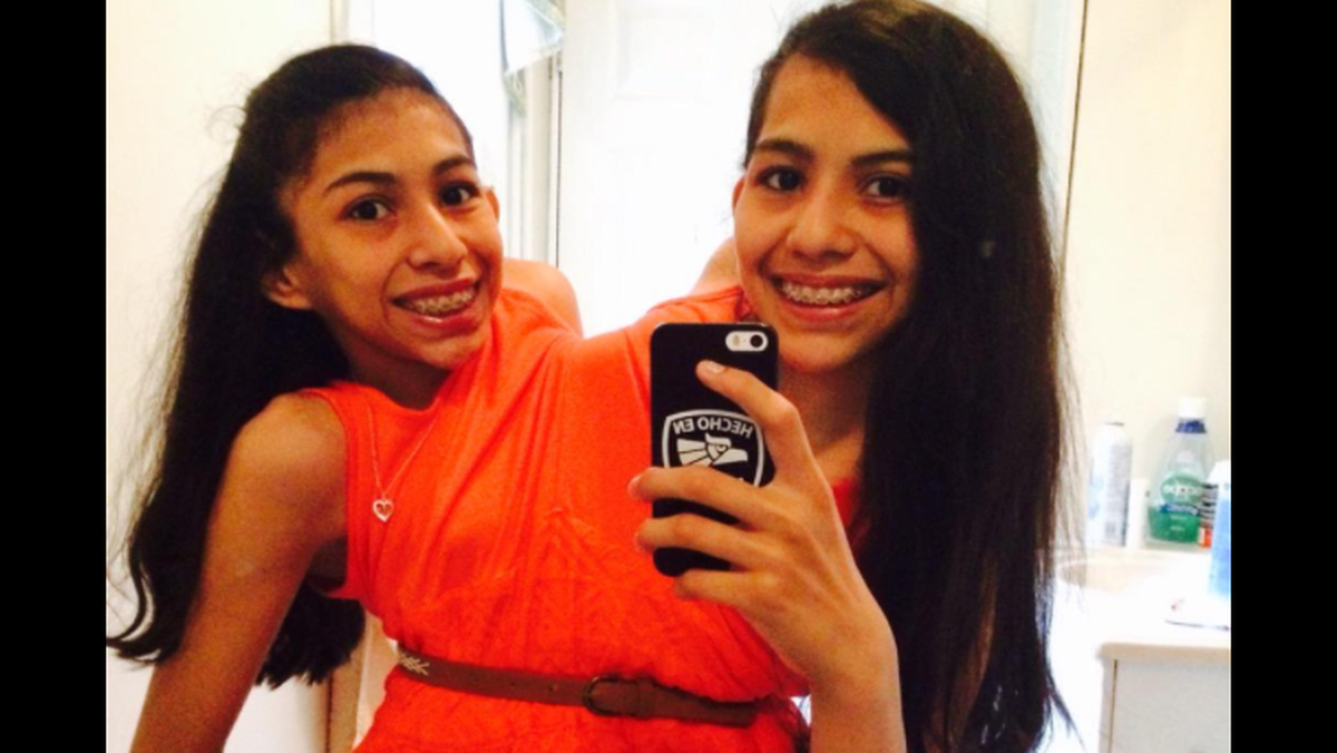 Kisah Kembar Dempet yang Tak Terpisahkan Hingga Remaja