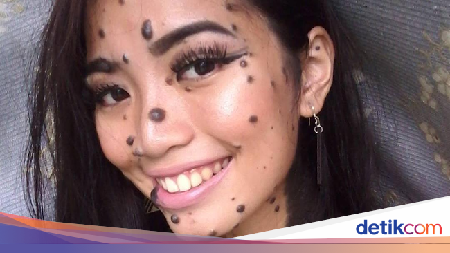 Wajah Dan Tubuh Dipenuhi Tahi Lalat Gadis Ini Ikut Kontes Kecantikan