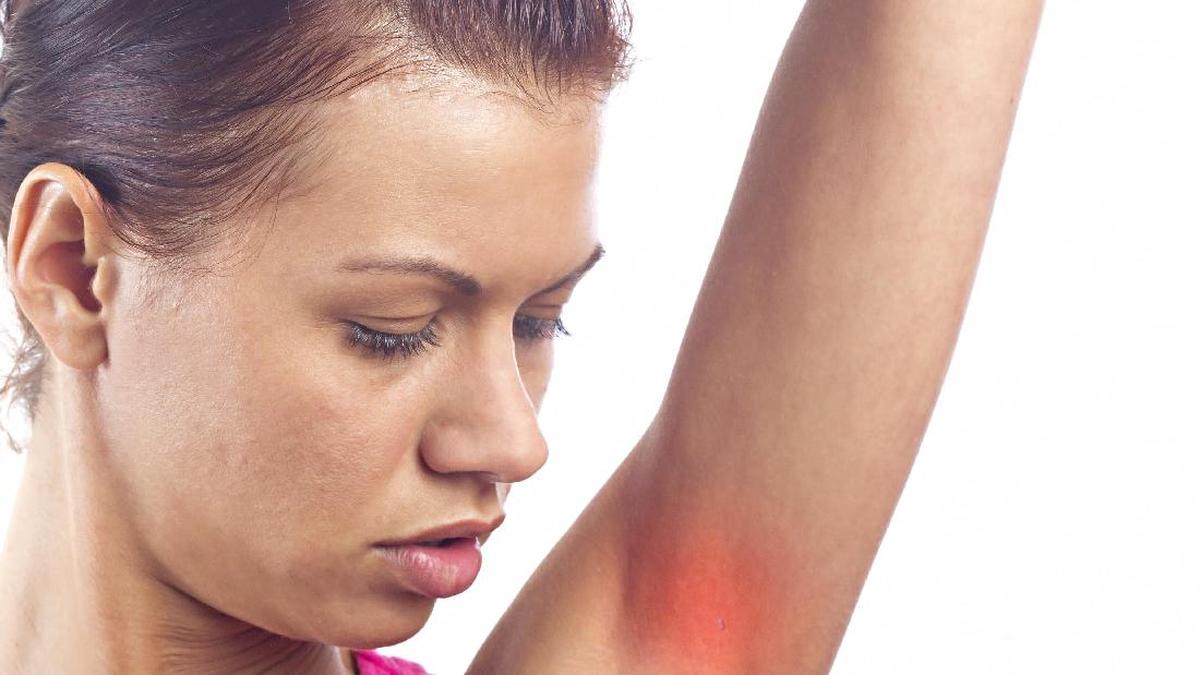 Gatal-gatal Setelah Cabut Rambut Ketiak? Waspada Folikulitis