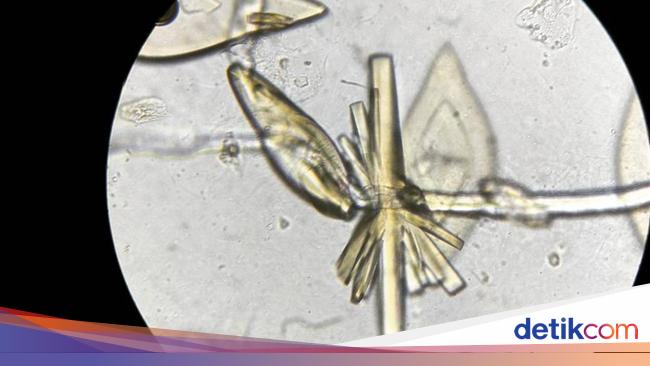 Foto: Kristal-kristal Cantik Asam Urat dalam Tangkapan Lensa Mikroskop