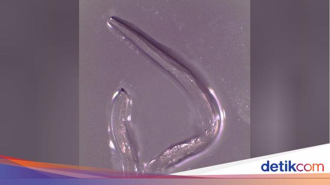 Hii! Dokter Angkat 14 Cacing dari Mata Wanita Ini