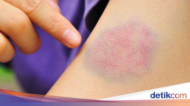 Memar Biru Muncul Tiba-tiba, Bukan Dijilat Setan Tapi Karena Hal Berikut