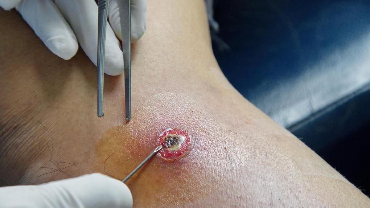 4 Obat Bisul Alami, Bisa Bikin Nanah Cepat Kering dan Sembuh