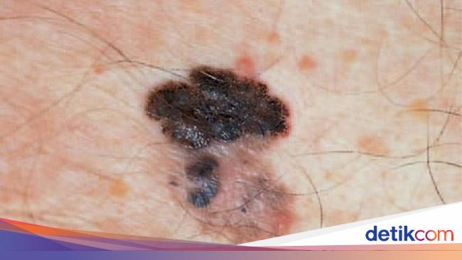Macam-macam Penampakan Kanker Kulit, Bedakan dengan Tahi Lalat!