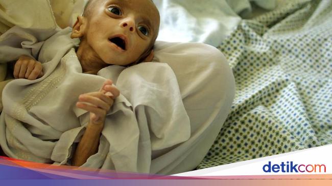 Marasmus: Penyebab, Gejala, Komplikasi, dan Pengobatannya
