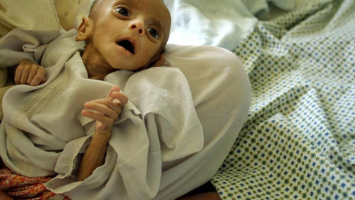 Marasmus: Penyebab, Gejala, Komplikasi, dan Pengobatannya