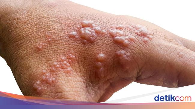 Cacar Api: Pengertian, Penyebab, Gejala, dan Cara Mengobati