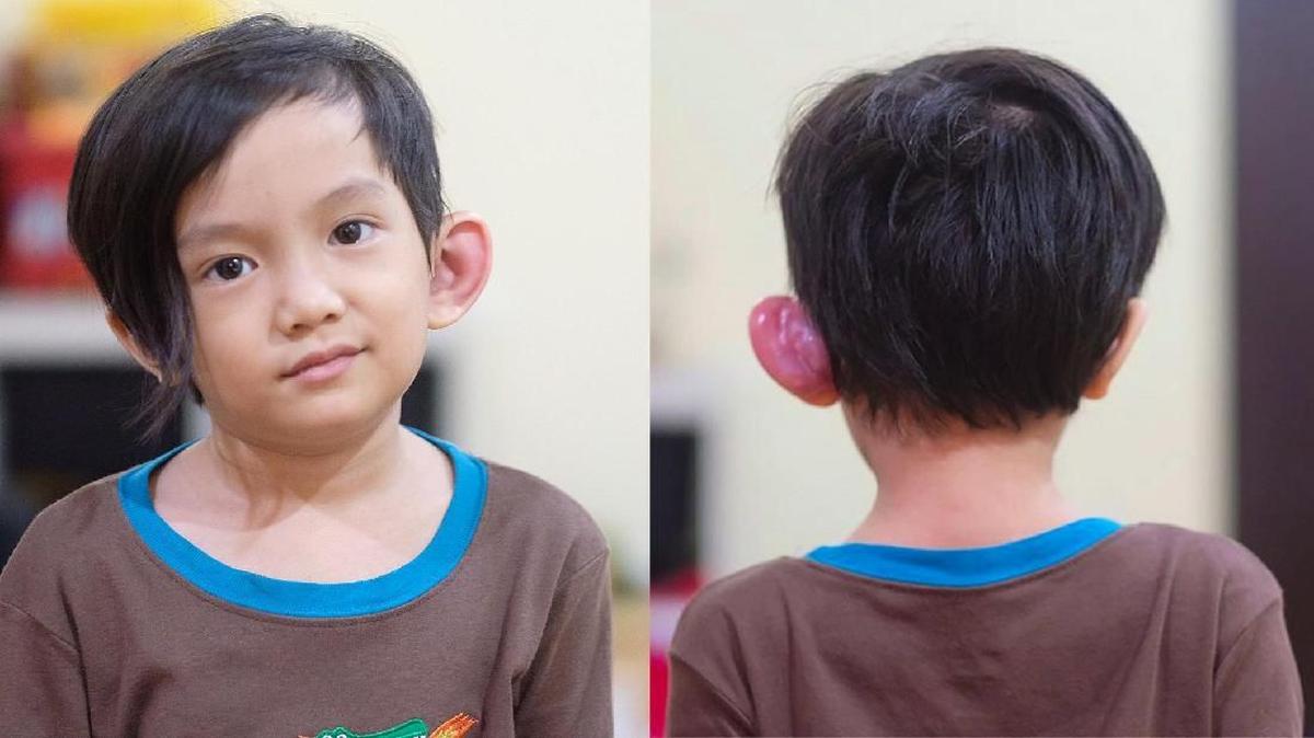 Sinus Preauricular, Kondisi yang Bikin Telinga Anak Anji Merah dan Bengkak