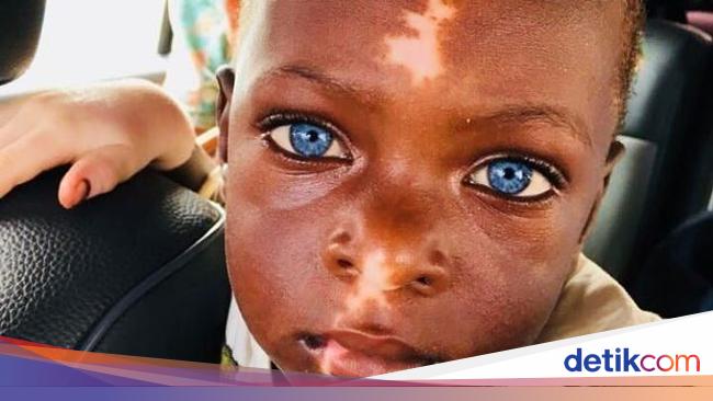 Mereka Bermata Biru Indah Karena Sindrom Waardenburg