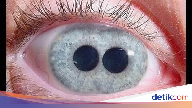Mengenal Polycoria, Satu Mata Memiliki Dua Pupil atau Lebih