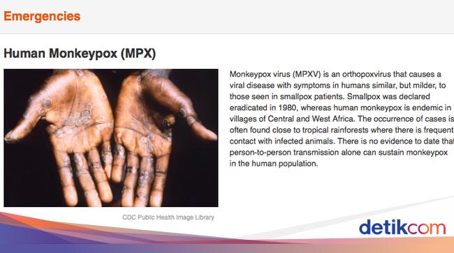 Wajib Tahu Ini Perbedaan Cacar Monyet Dan Cacar Air - Riset