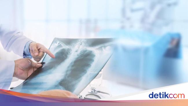 10 Jenis Infeksi Paru-paru, Gejala, Penyebab, dan Penanganannya