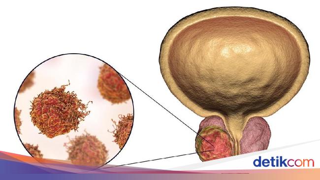 Kanker Prostat: Penyebab, Gejala, dan Cara Mencegah