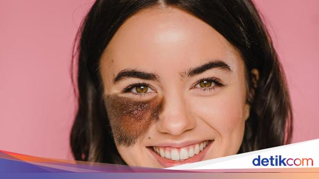 Ada Tompel Berbulu di Wajah, Kecantikan Wanita Ini Viral dan Menginspirasi