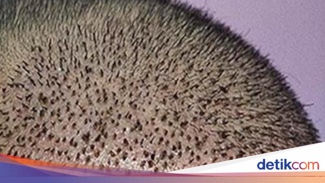 Botak Sudah Bukan Masalah Lagi Bagi Pria, Ada Obatnya!