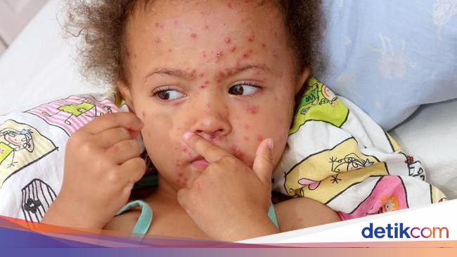 WHO: 110.000 Orang Meninggal Akibat Campak dan Rubella