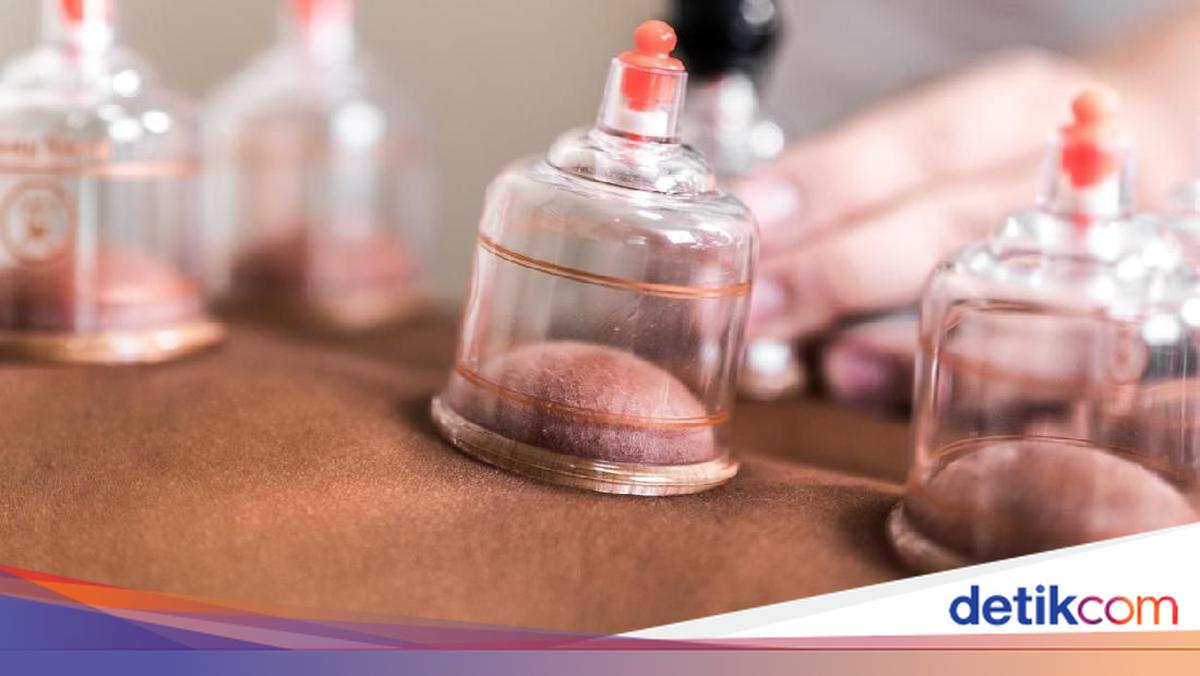 6 Titik Bekam Sunnah Rasulullah untuk Kesembuhan Penyakit