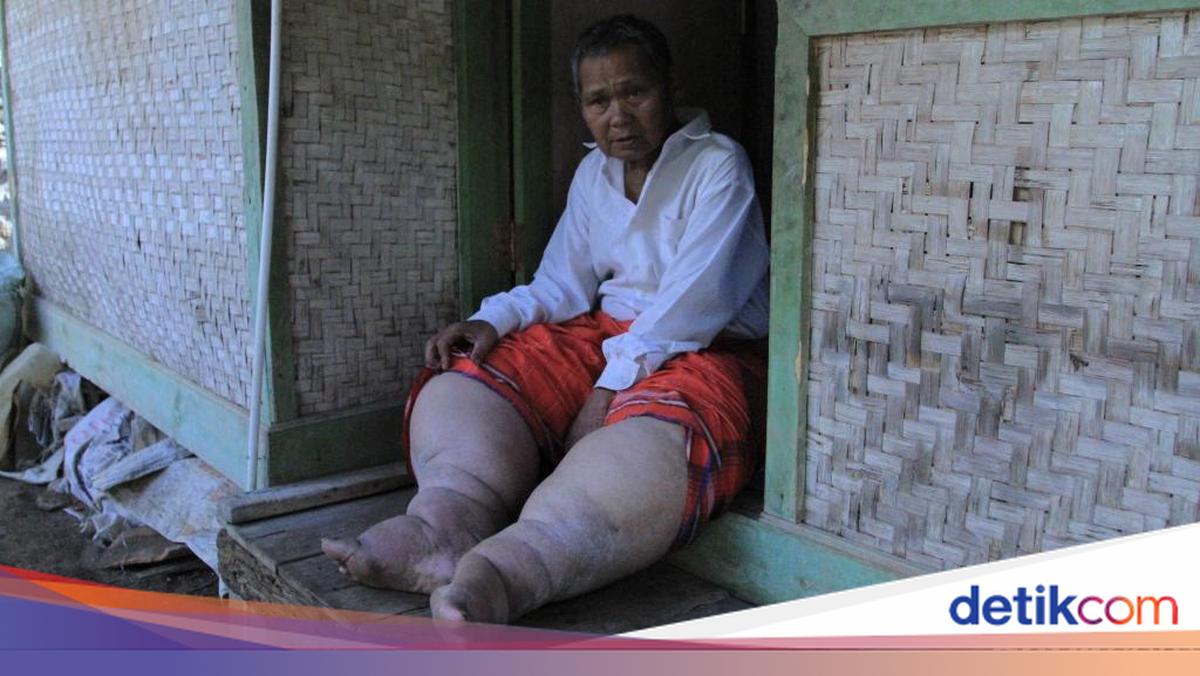 Sakit Kaki Gajah, Warga Sumedang Butuh Pengobatan dan Rutilahu
