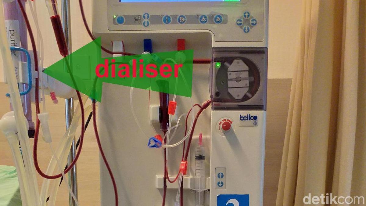 Mengenal Alat Cuci Darah yang 'Selangnya' Sempat Jadi Heboh