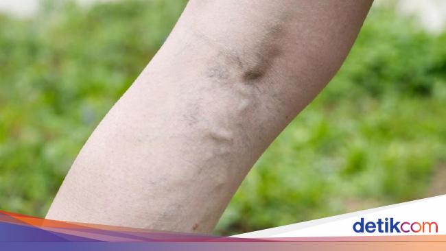 Muncul Urat Biru di Belakang Lutut dan Paha, Gejala Varises? Begini ...