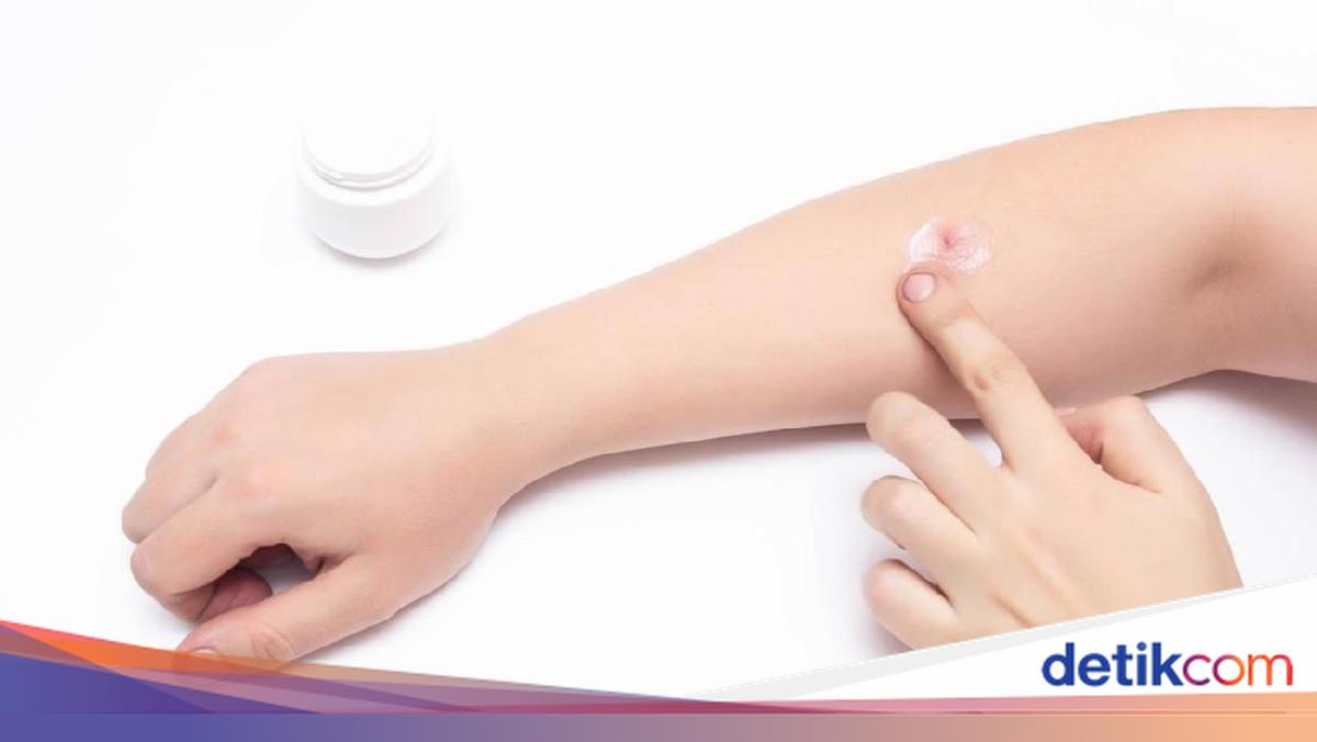Apa Penyebab Timbulnya Bisul? Berikut Penjelasan dan Cara Menanganinya