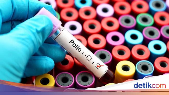 RI KLB Polio! Ini Gejala, Penyebab, hingga Cara Mencegahnya