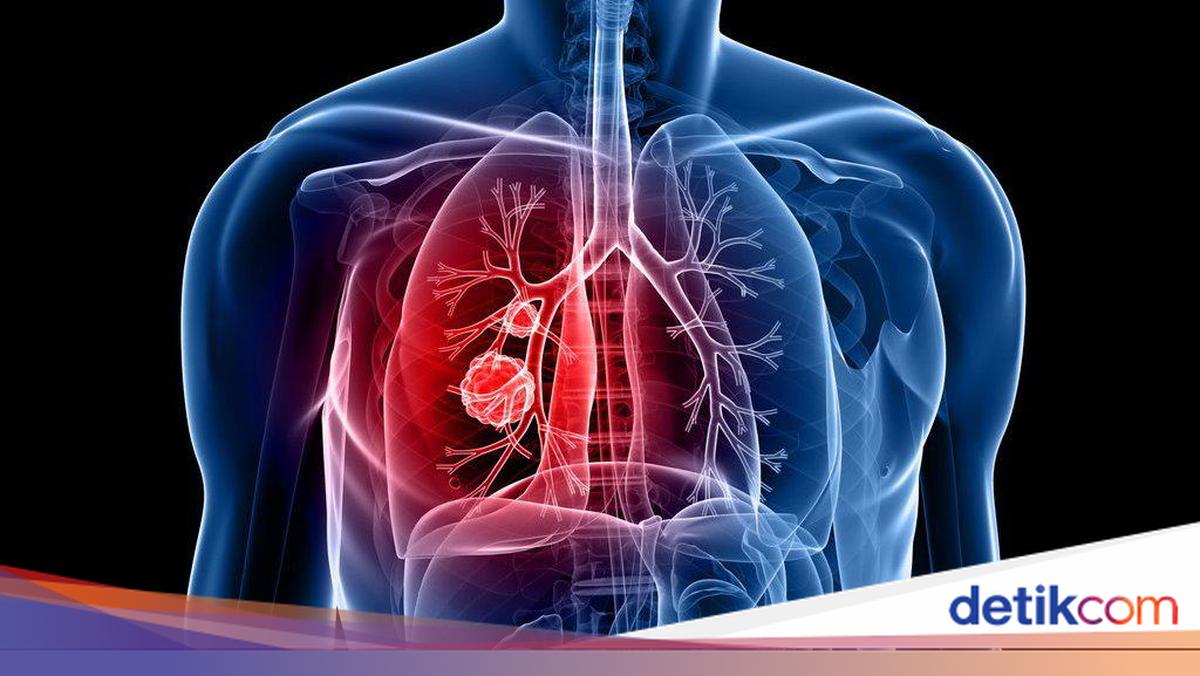 Konsumsi 5 Makanan Ini Agar Paru-paru Tetap Sehat