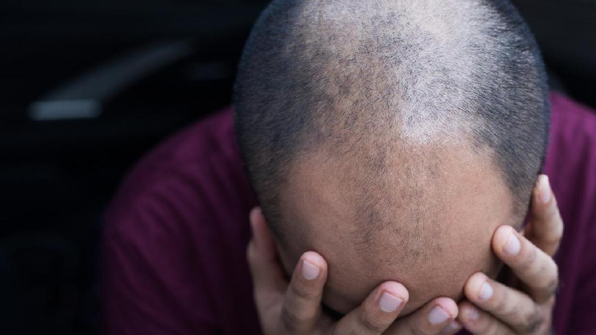 Apa Itu Alopecia? Kondisi yang Bikin Rambut Mendadak Rontok
