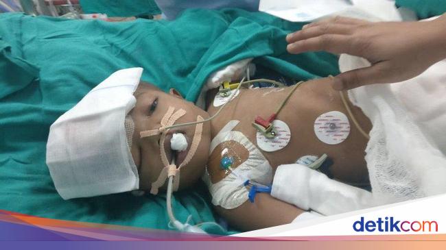 Kembar Siam Dempet Kepala Meninggal 3 Tahun Usai Operasi Pemisahan