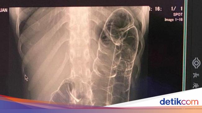 Wanita Sering Alami Sembelit Bagikan Foto Rontgen Ususnya yang Bikin Syok