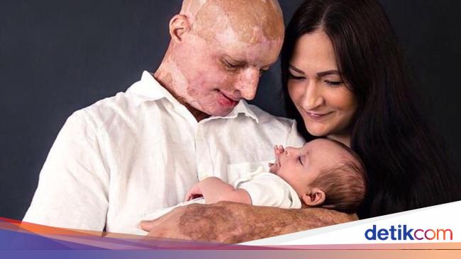 Potret Pria Berwajah Rusak karena Disiram Air Keras Oleh Mantan Kekasihnya