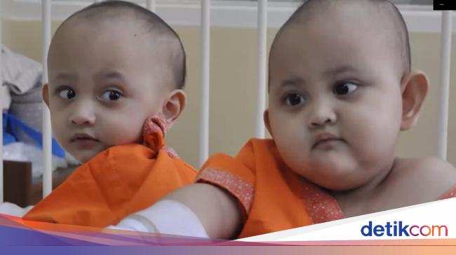 RSAB Harapan Kita Pisahkan Kembar Siam Dempet Tulang Ekor Naifa-Nayyara