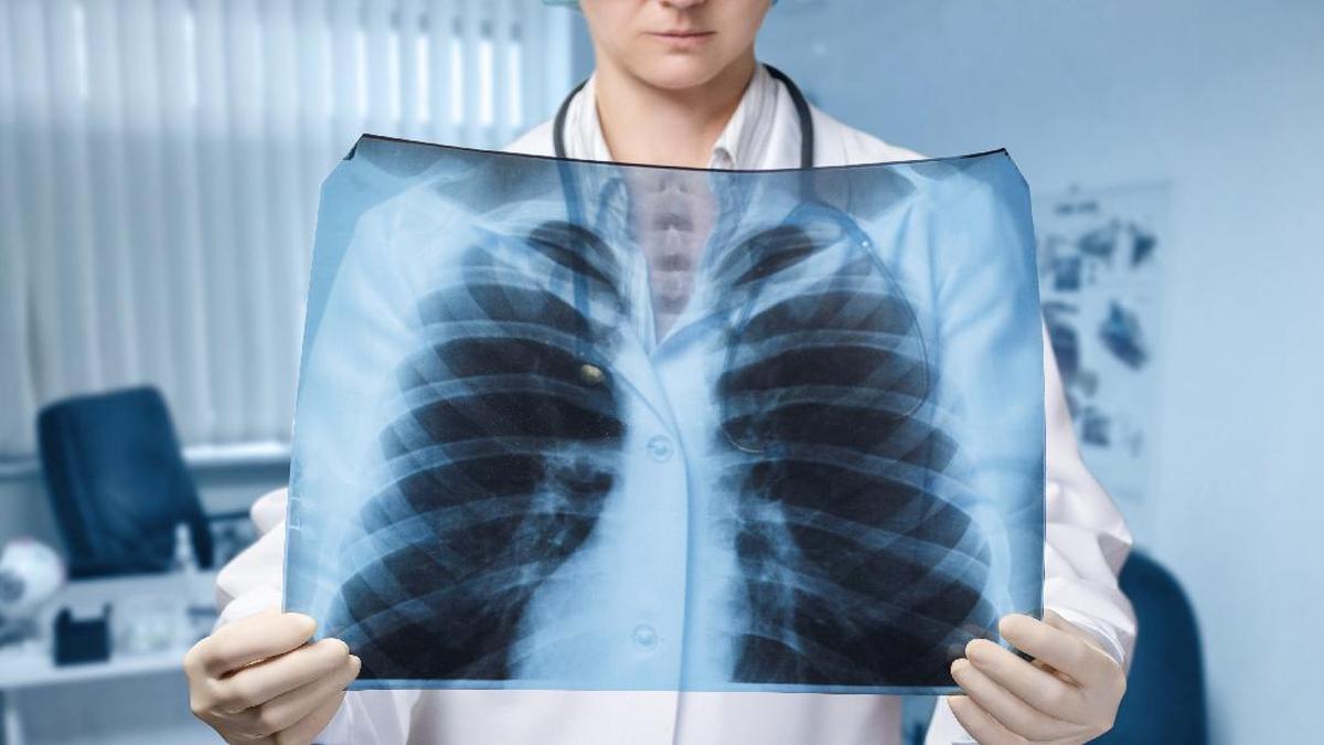 Apa Itu Pneumonia? Penyakit Pernapasan yang Beda dengan Paru-paru Basah