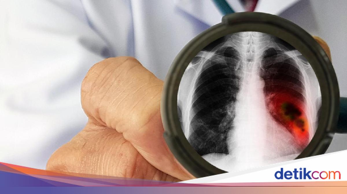 Kenali Gejala Kanker Paru dan Cara Mencegahnya