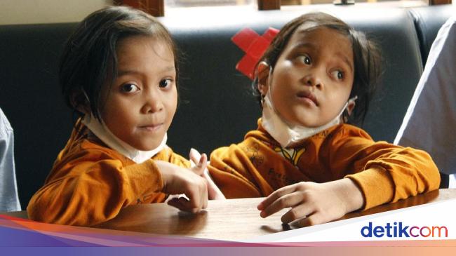 Kisah Bocah Kembar Siam Dempet Perut Asal Garut