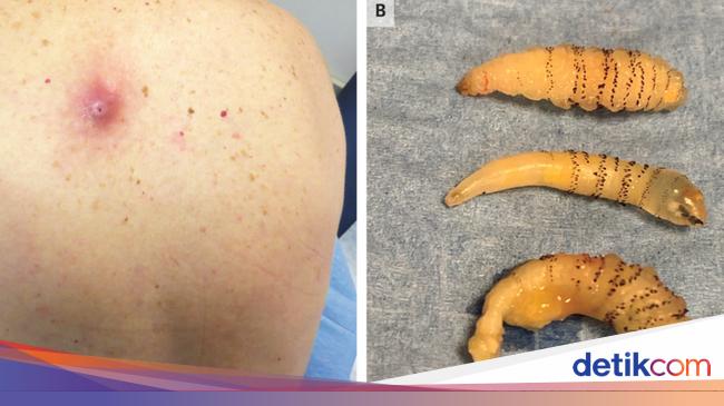 Bentol Dikira Gigitan Nyamuk, Tak Tahunya Ada Parasit di Kulit Wanita Ini