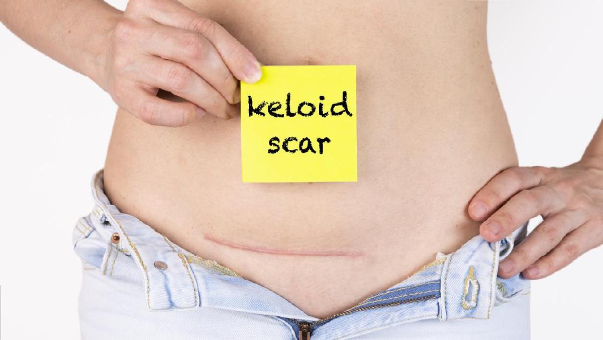 Muncul Keloid Usai Operasi Caesar? Ini 4 Cara Menyamarkannya