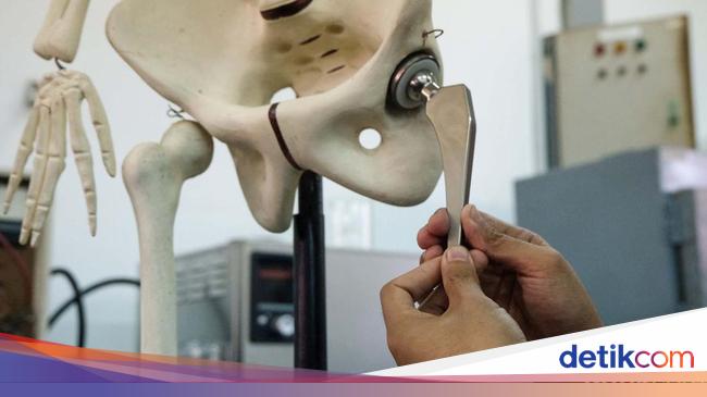 BRIN Kembangkan Implan Pengganti Sendi Buatan dalam Negeri